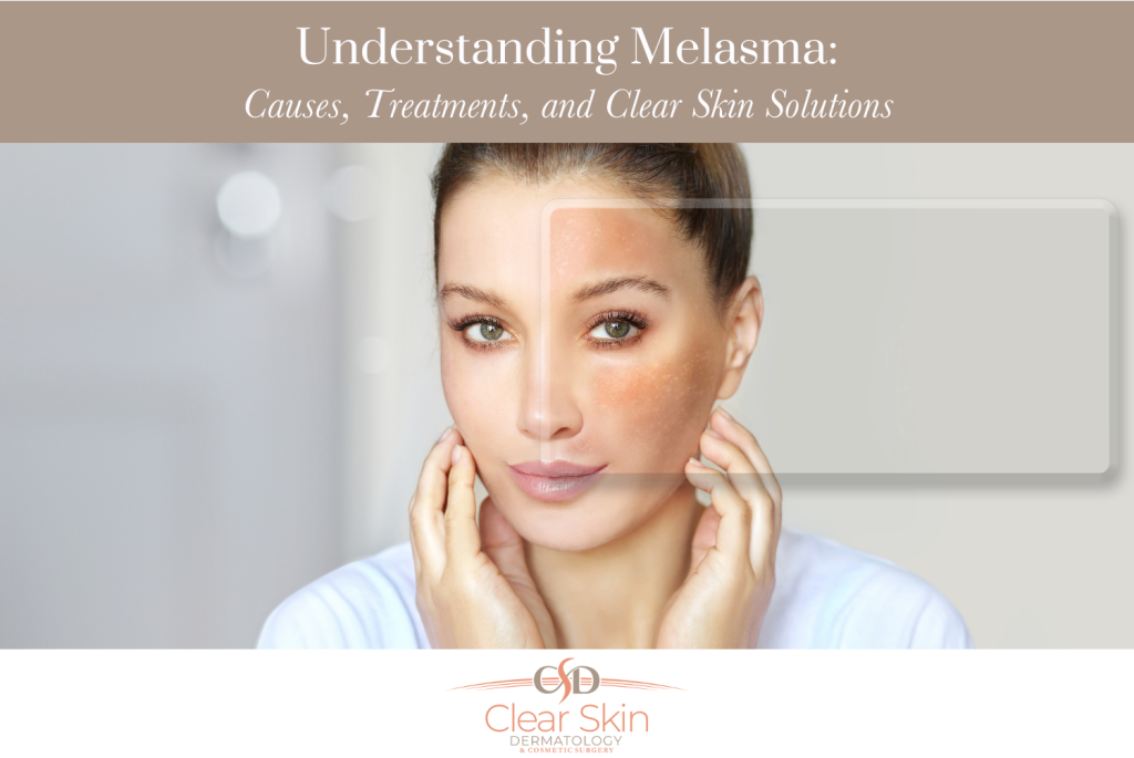 Understanding Melasma:Causes, Treatments, and Clear Skin Solutions ...